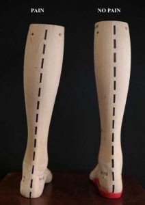 Limb Length Discrepancy Consultant | Orthotics Online
